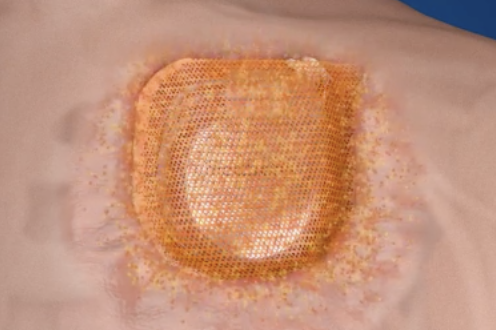 Commercialization – Laboratory for Biomaterials Research